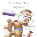 Accurate Education - Facet Joint Injections and Nerve Procedures ...